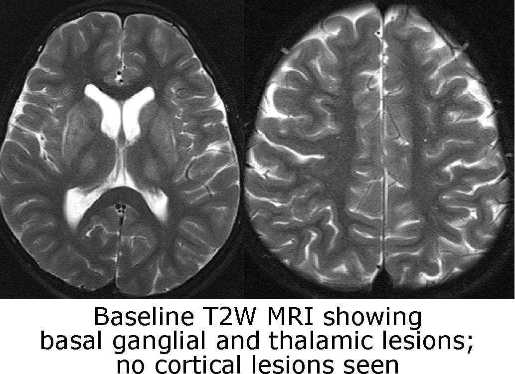 Explosive flurry of seizures and new-onset cortical-subcortical lesions in a patient with Wilson ...